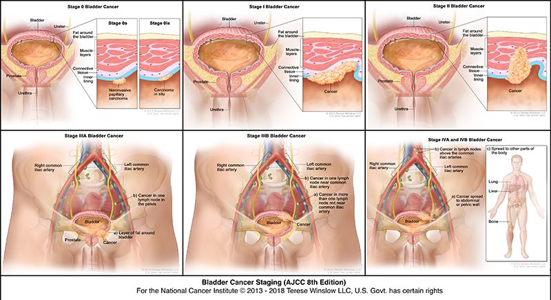 Bladder Cancer Staging